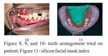 Full mouth rehabilitation with implant-supported fixed dental ...