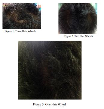 Multiple Hair Whorls
