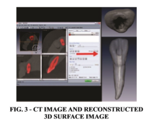 Improvement Of Dental Fiberscope Navigation System For Endodontic ...