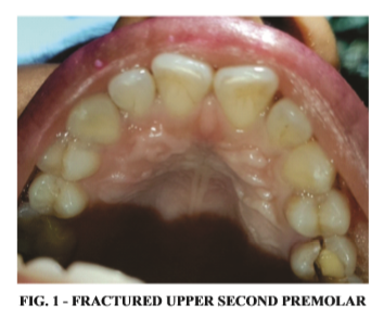 Reattach to Rebond; Restorative Management of a subgingival crown fracture