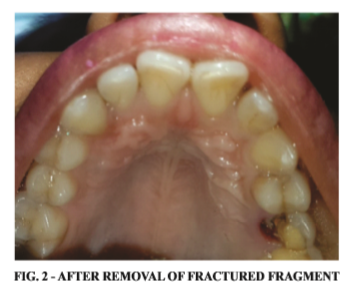 Reattach to Rebond; Restorative Management of a subgingival crown fracture
