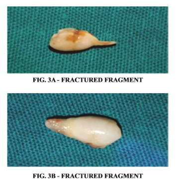Reattach to Rebond; Restorative Management of a subgingival crown fracture