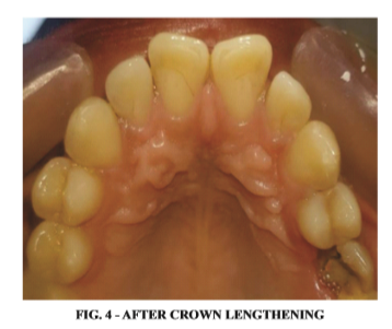 Reattach to Rebond; Restorative Management of a subgingival crown fracture