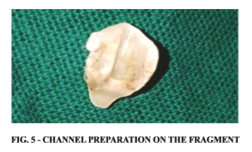 Reattach to Rebond; Restorative Management of a subgingival crown fracture