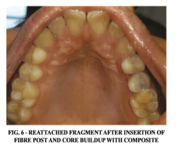 Reattach to Rebond; Restorative Management of a subgingival crown fracture