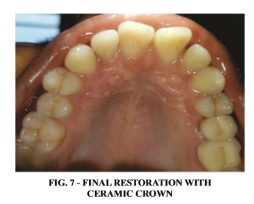 Reattach to Rebond; Restorative Management of a subgingival crown fracture