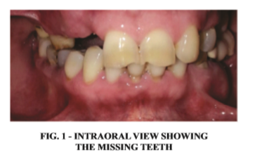 Maxillary Fixed-Fixed FPD With Precision Attachment: A Clinical Report