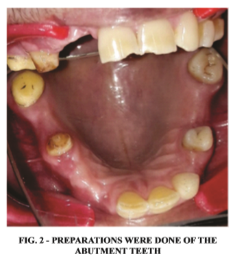 Maxillary Fixed-Fixed FPD With Precision Attachment: A Clinical Report