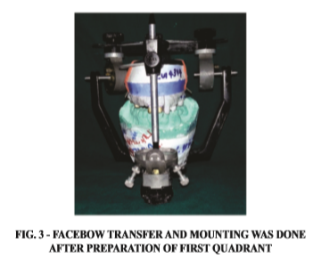 Maxillary Fixed-Fixed FPD With Precision Attachment: A Clinical Report