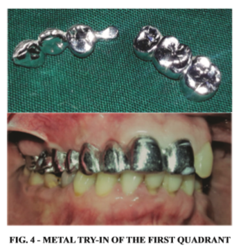 Maxillary Fixed-Fixed FPD With Precision Attachment: A Clinical Report