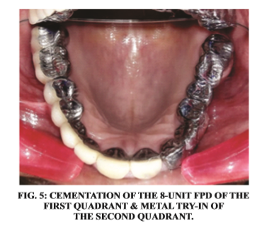 Maxillary Fixed-Fixed FPD With Precision Attachment: A Clinical Report