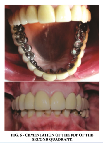 Maxillary Fixed-Fixed FPD With Precision Attachment: A Clinical Report
