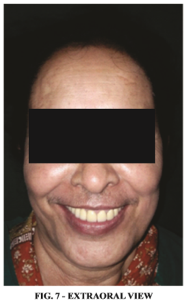 Maxillary Fixed-Fixed FPD With Precision Attachment: A Clinical Report