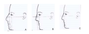 First Molar Extraction In Class III Malocclusion In Adult Patients