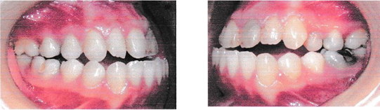 First Molar Extraction In Class III Malocclusion In Adult Patients
