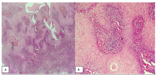 Granulomatosis with polyangiitis(wegener’s granulomatosis); an ...
