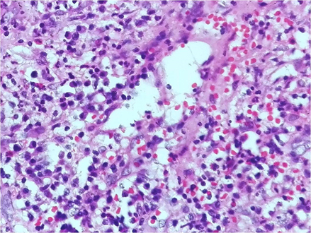 Granulomatosis with polyangiitis(wegener’s granulomatosis); an ...