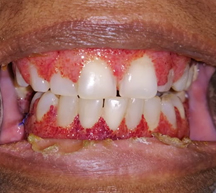 Granulomatosis with polyangiitis(wegener’s granulomatosis); an ...