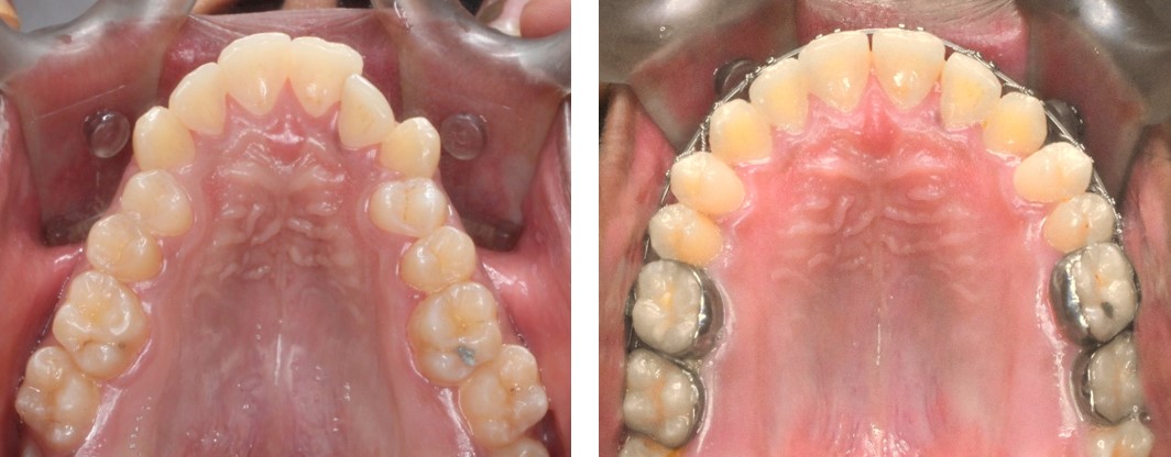Rapid correction of constricted maxillary arch in a class III patient ...
