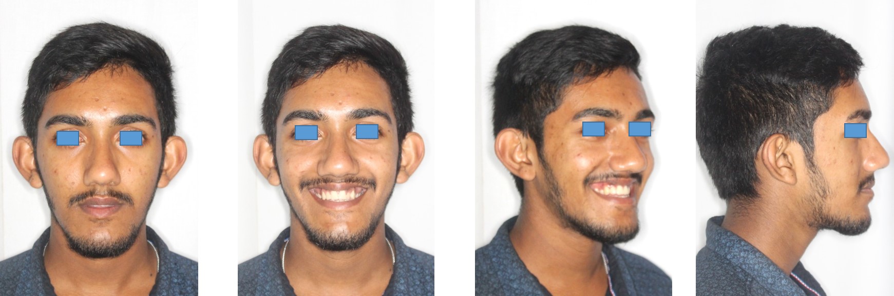 Rapid correction of constricted maxillary arch in a class III patient ...