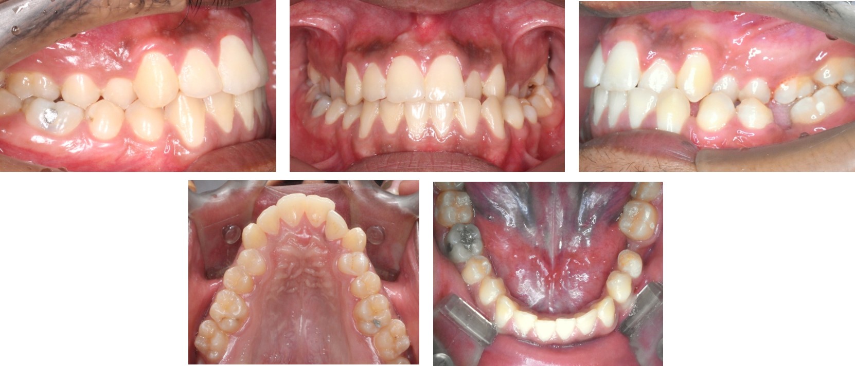 Rapid correction of constricted maxillary arch in a class III patient ...
