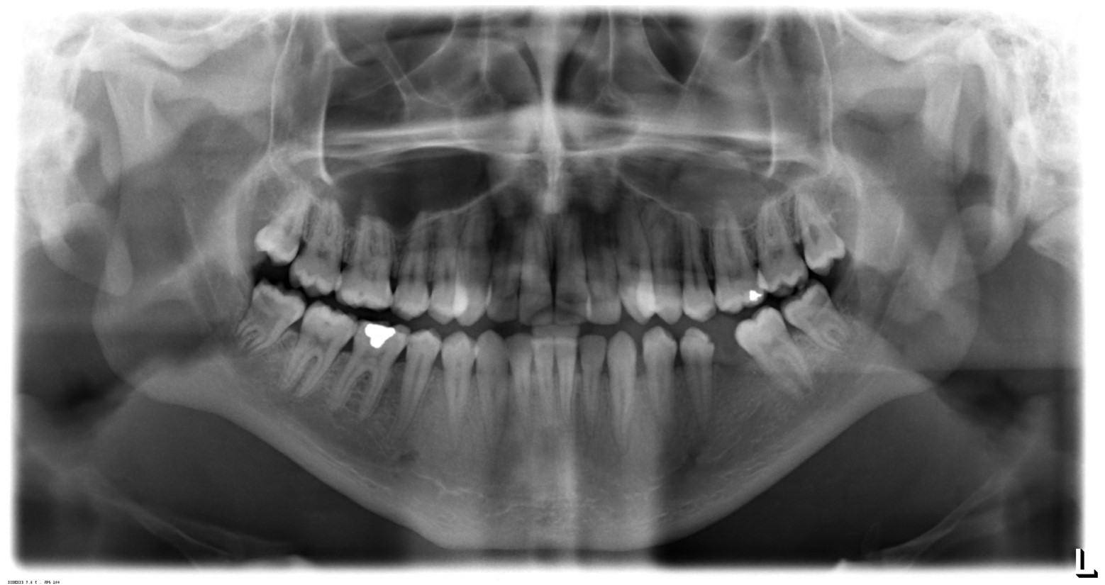 Rapid correction of constricted maxillary arch in a class III patient ...