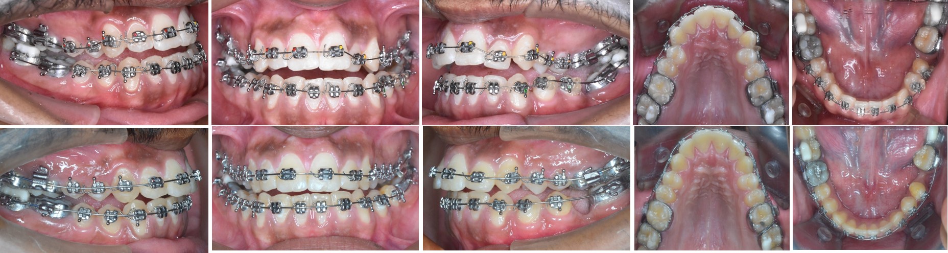 Rapid correction of constricted maxillary arch in a class III patient ...