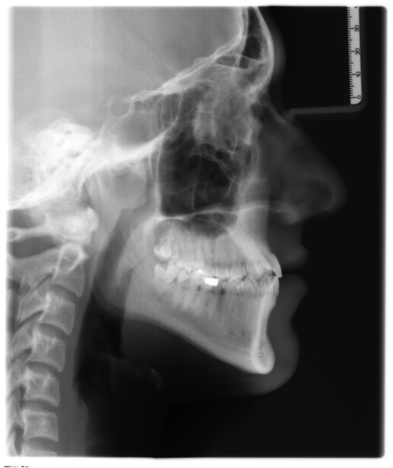 Rapid correction of constricted maxillary arch in a class III patient ...