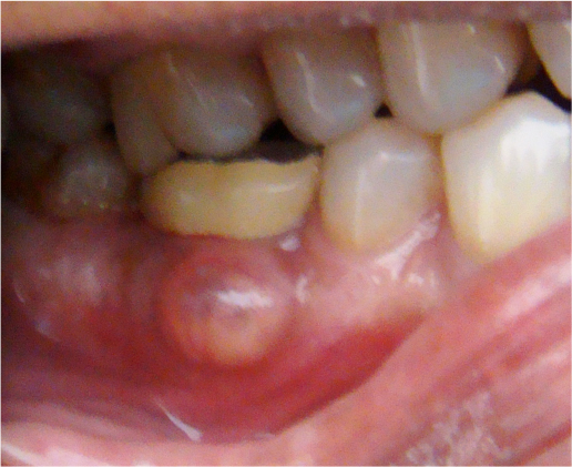 Conventional flap versus laser assisted periodontal surgery in the ...