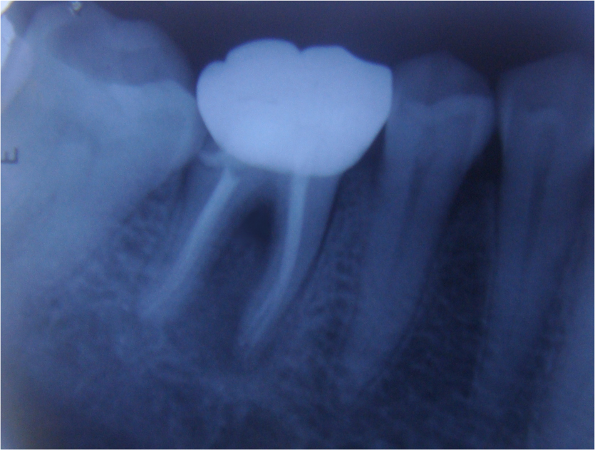 Conventional flap versus laser assisted periodontal surgery in the ...
