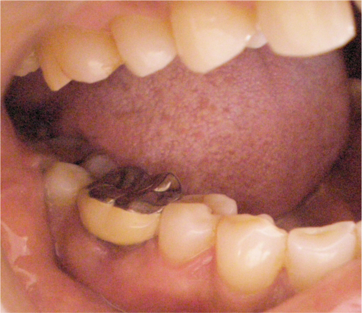 Conventional flap versus laser assisted periodontal surgery in the ...