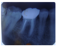 Conventional flap versus laser assisted periodontal surgery in the ...