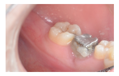 Conventional flap versus laser assisted periodontal surgery in the ...