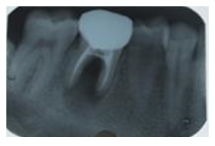 Conventional flap versus laser assisted periodontal surgery in the ...